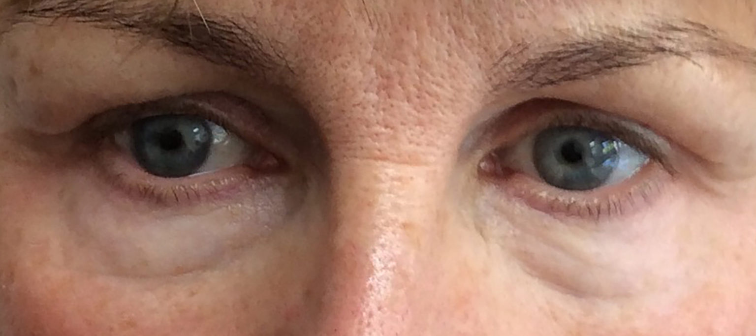 Tear Trough Filler Treatment London, UK | Under Eye Dermal Filler ...
