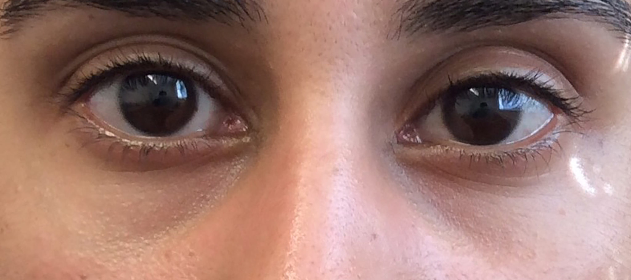 Tear Trough Filler Treatment London, UK | Under Eye Dermal Filler ...