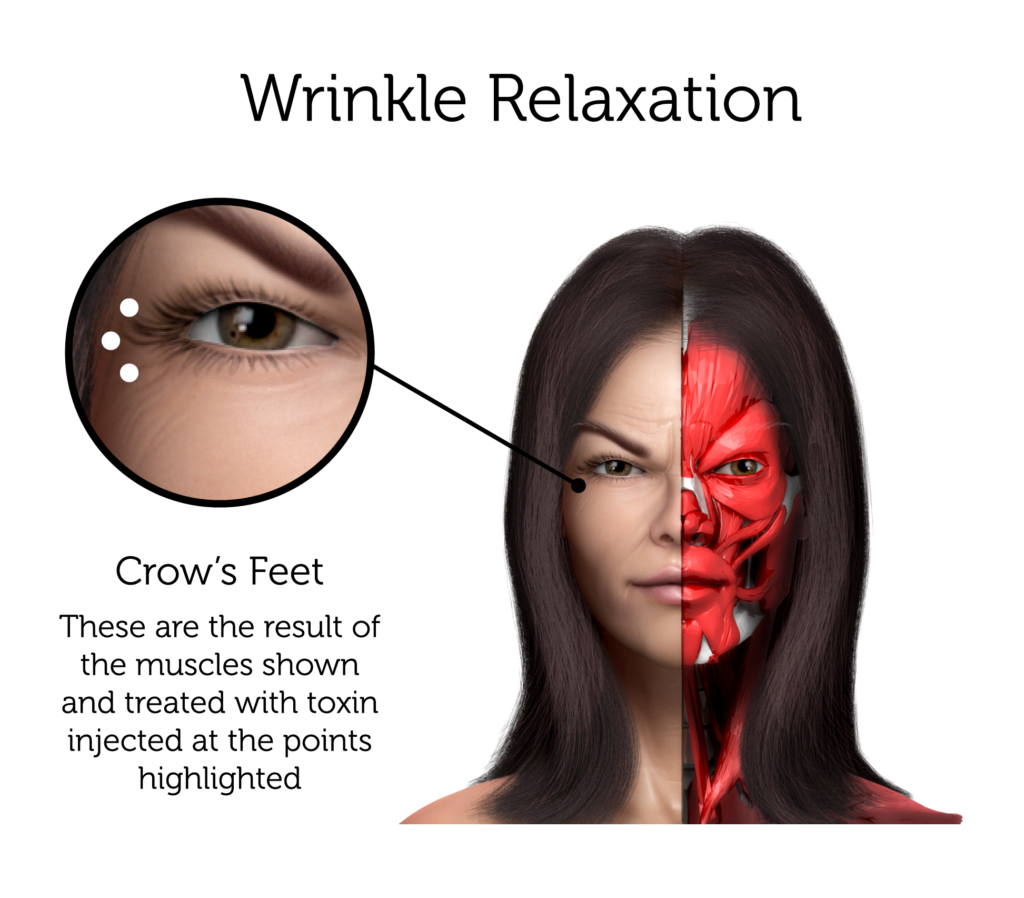 Crow’s Feet & Frown Lines London | Rejuvence Clinic