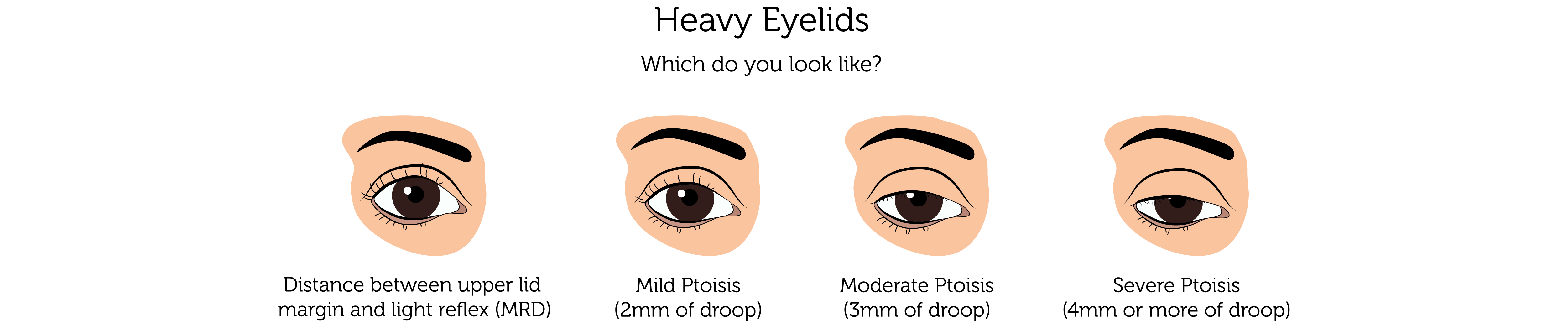 Heavy Eyelids London Rejuvence Clinic Heavy Eyelids London Rejuvence Clinic