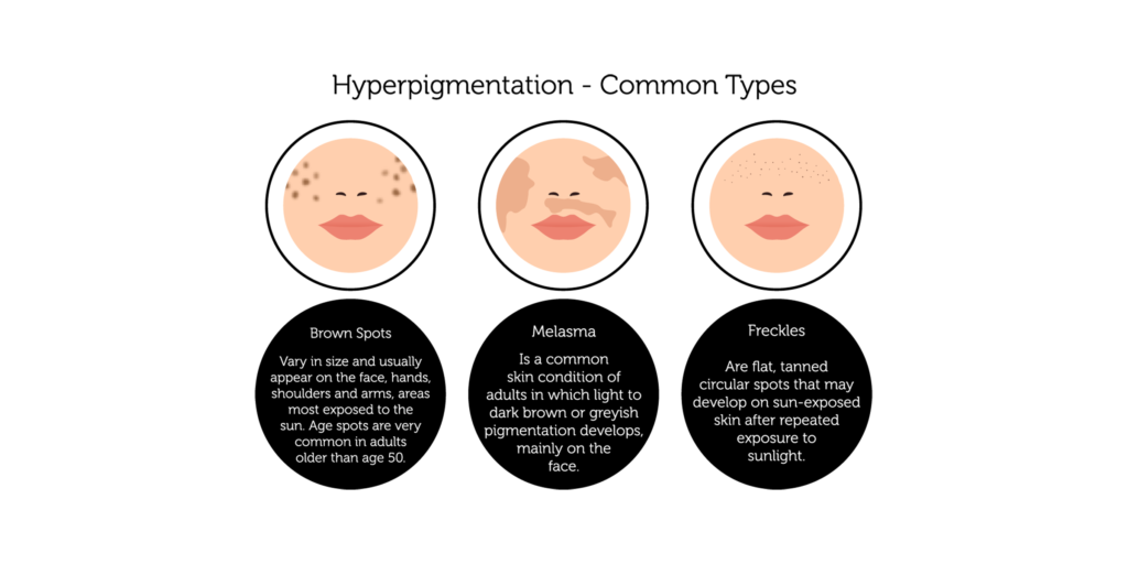 Hyperpigmentation Treatment London,UK | Rejuvence Clinic