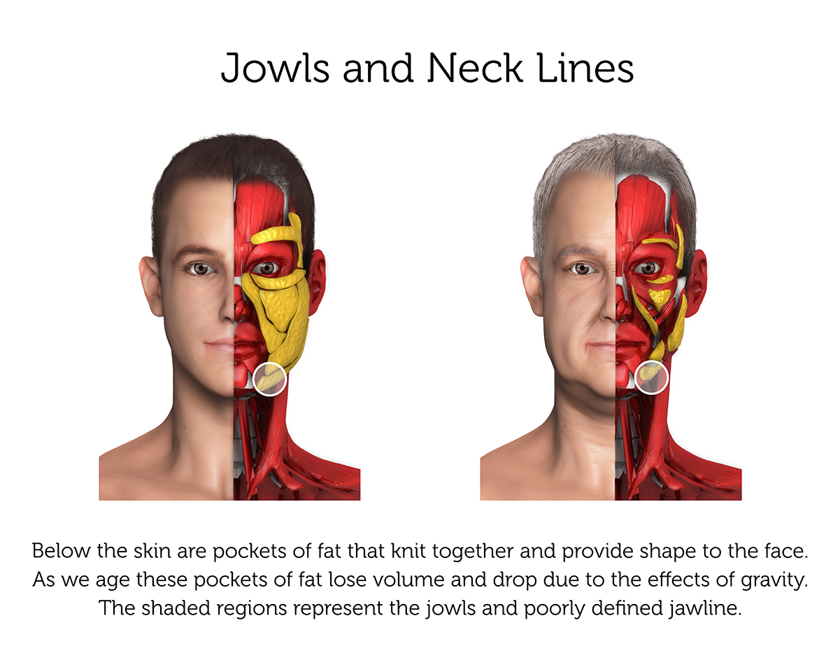 What Are Face Jowls At Albert Hoopes Blog
