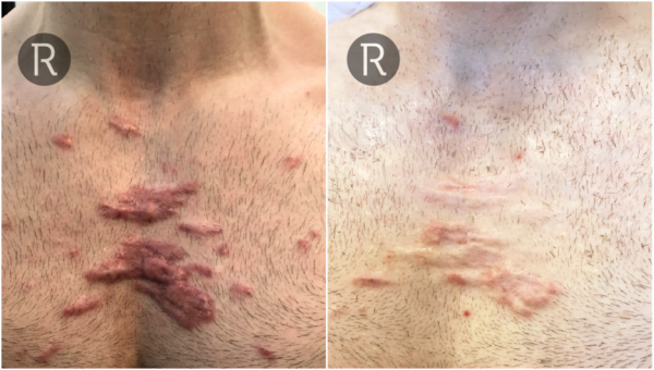Body Keloids